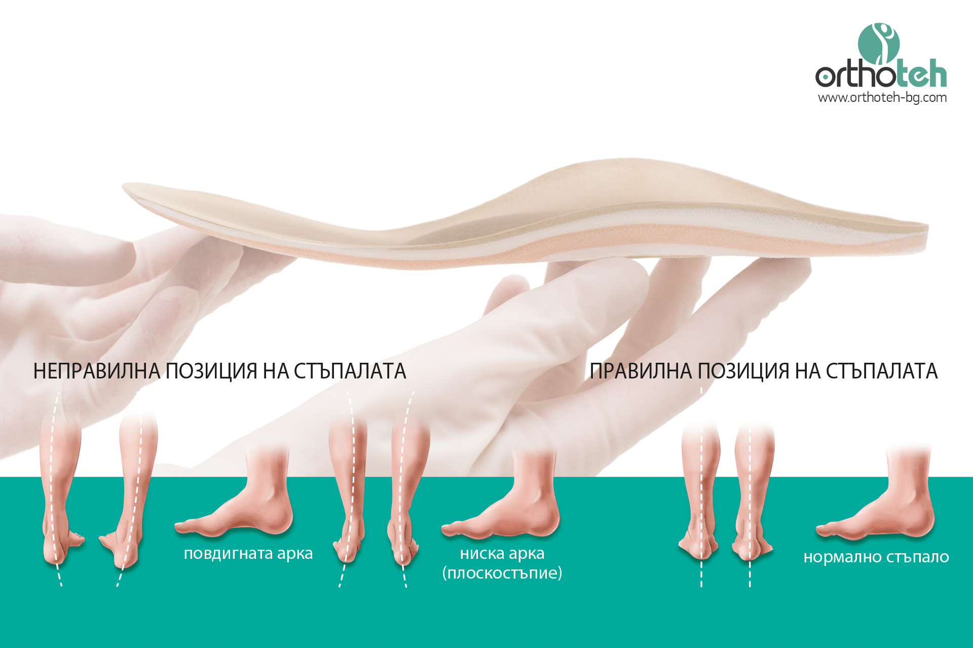 Flatfoot – what causes it? | ORTHOTEH BLOG